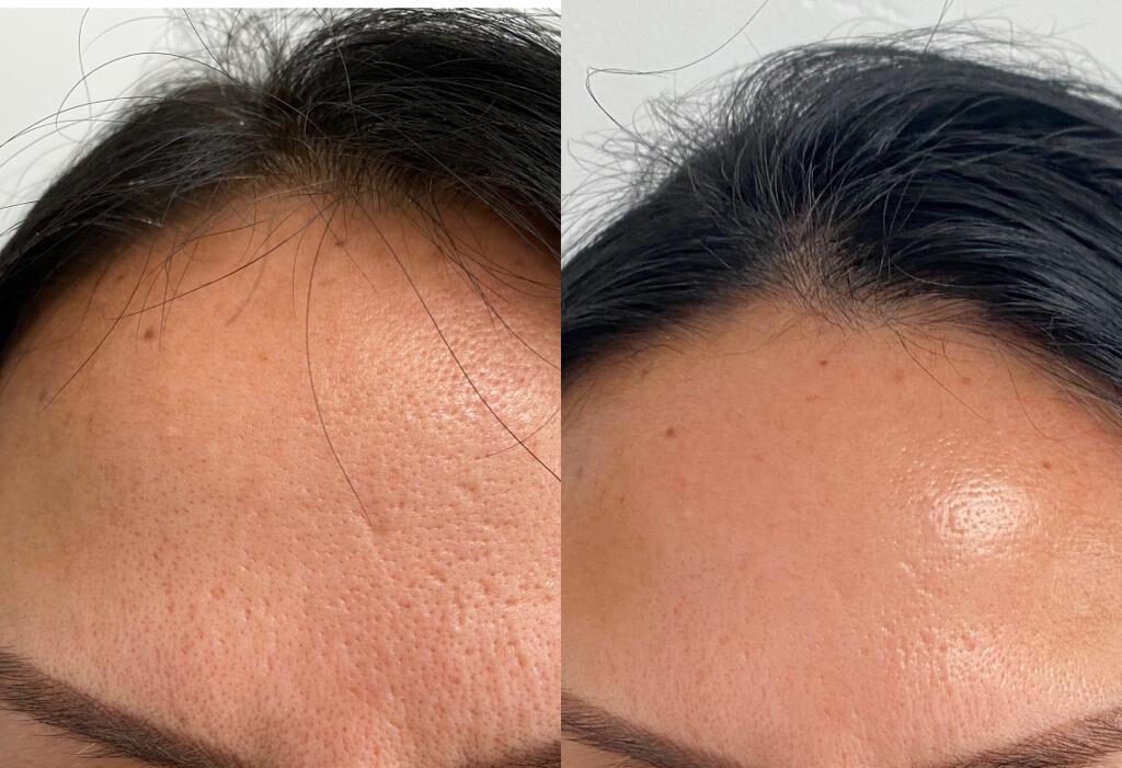 Microneedling Cuijk | Huidvernieuwing, Acné-littekens ...